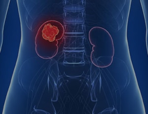 Kidney Cancer Treatment | Bellingham | North Cascade Cancer Center